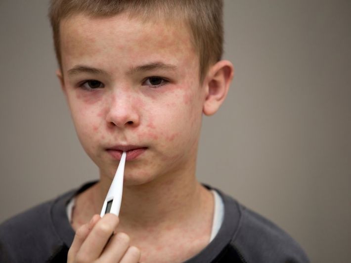 Measles Symptoms in Children: A Guide to Recognizing and Managing It