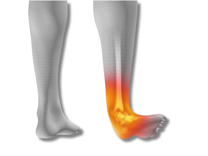 Ankle Sprain: Steps and Tips for a Quick Recovery