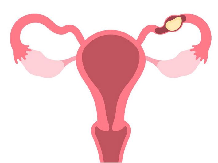 Ectopic Pregnancy