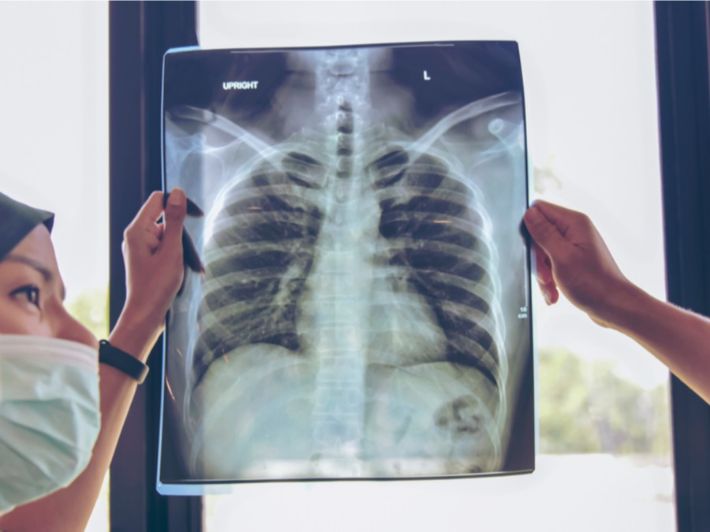 قائمة بأفضل وأسوأ الأكلات لمرضى سرطان الرئة - مرض السرطان - الدليل الشامل